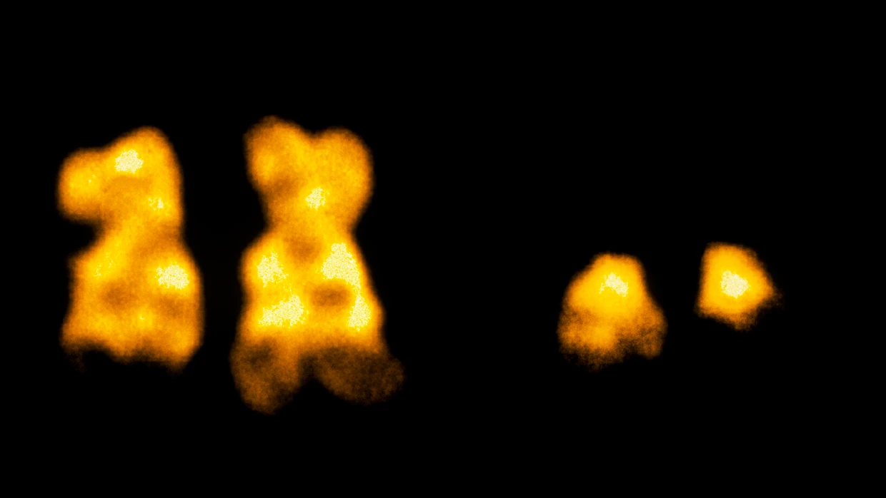Leukämie mit Philadelphia-Chromosom: Positive Ergebnisse in Studie | FAZ