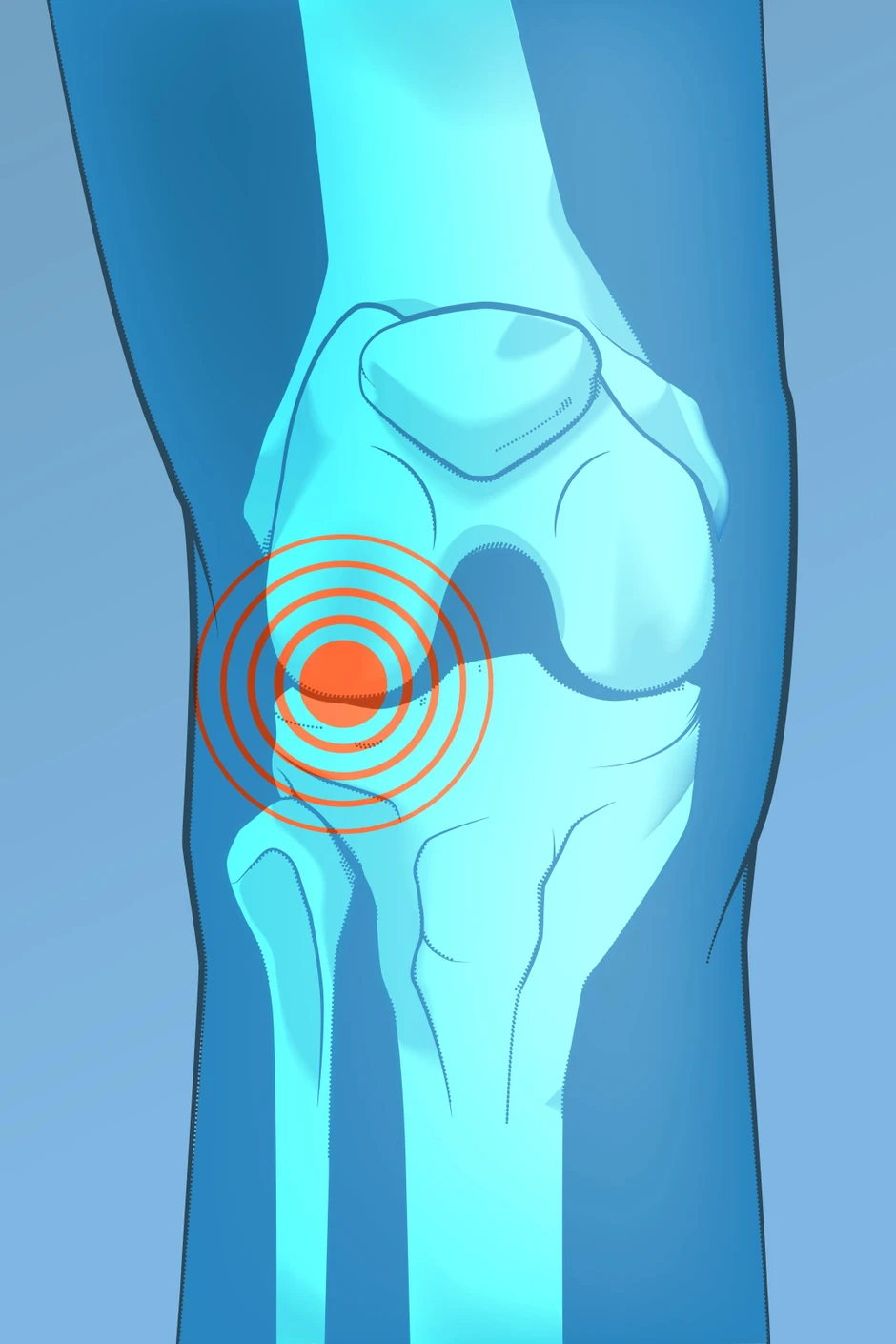 Arthrose im Knie: Knorpel-Rettung durch neue Methode möglich | FAZ