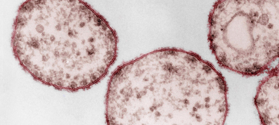 Masern: Das importierte Virus - Gesundheit - FAZ