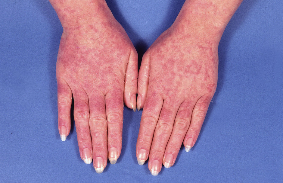 Lupus Erythematodes Merkblatt | Lupus erythematodes: Symptome ...